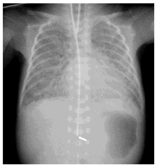 Children | Free Full-Text | Iatrogenic Esophageal Perforation in ...
