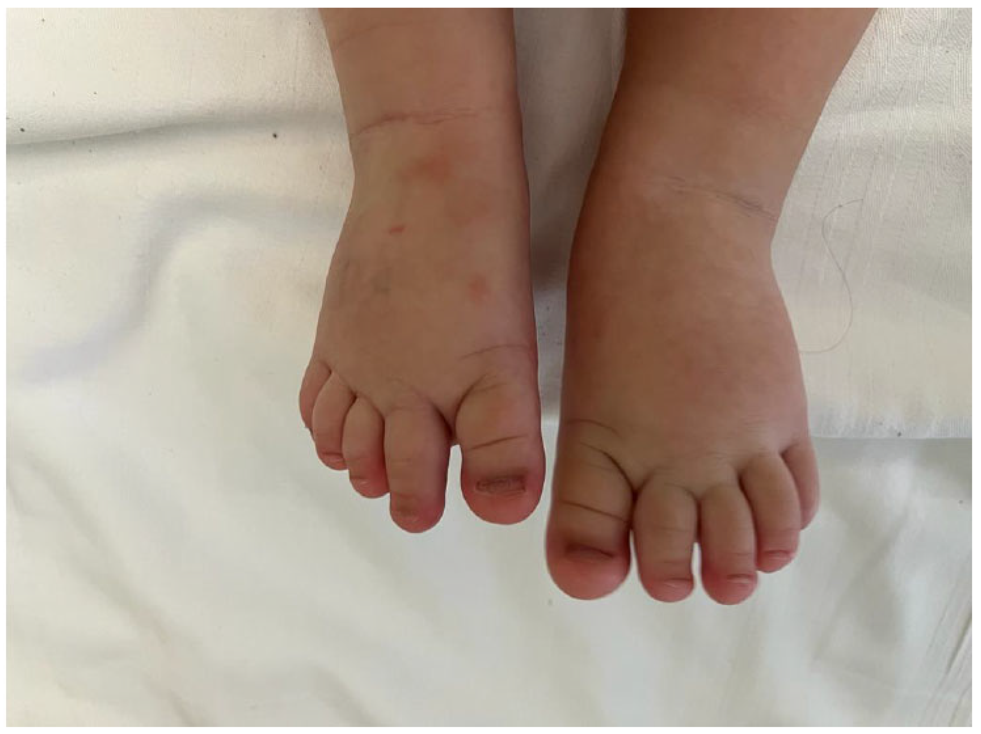 Klippel Trenaunay Syndrome