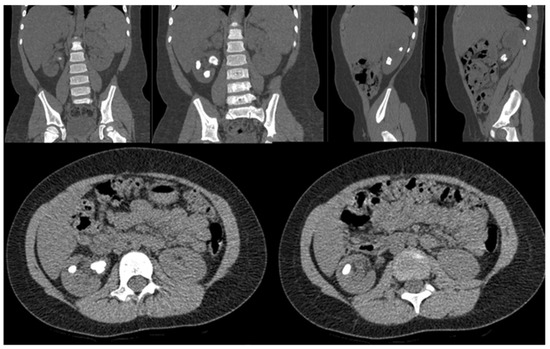 Pyeloplasty in Children with Ureteropelvic Junction Obstruction and ...