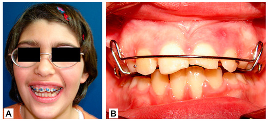 Oral Rehabilitation as Part of a Multidisciplinary Treatment in a Case ...