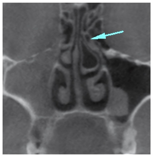Children | Free Full-Text | Association among Orthodontic Malocclusions ...