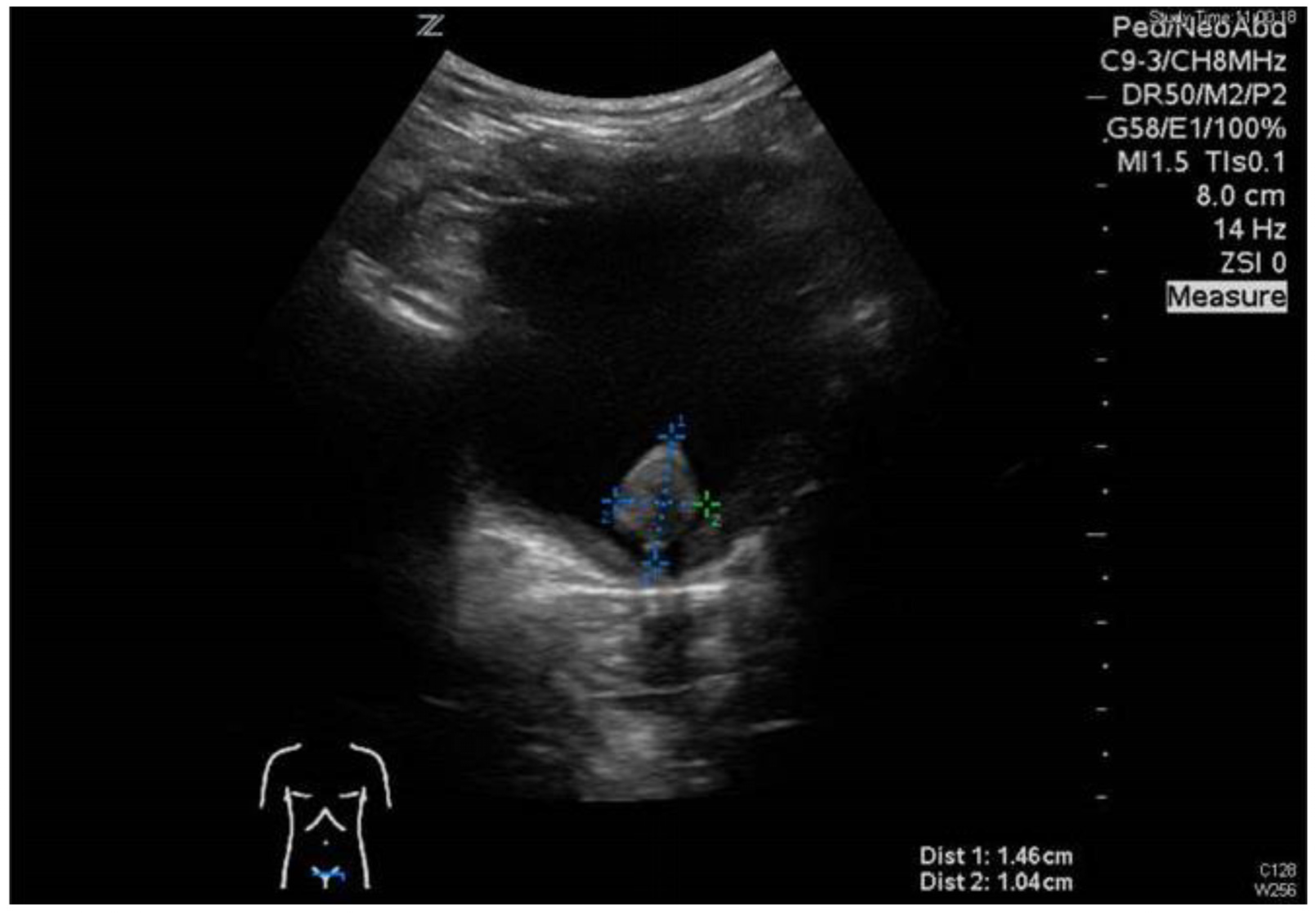 Bladder Neoplasia in Pediatric Patients—A Single-Center Experience ...