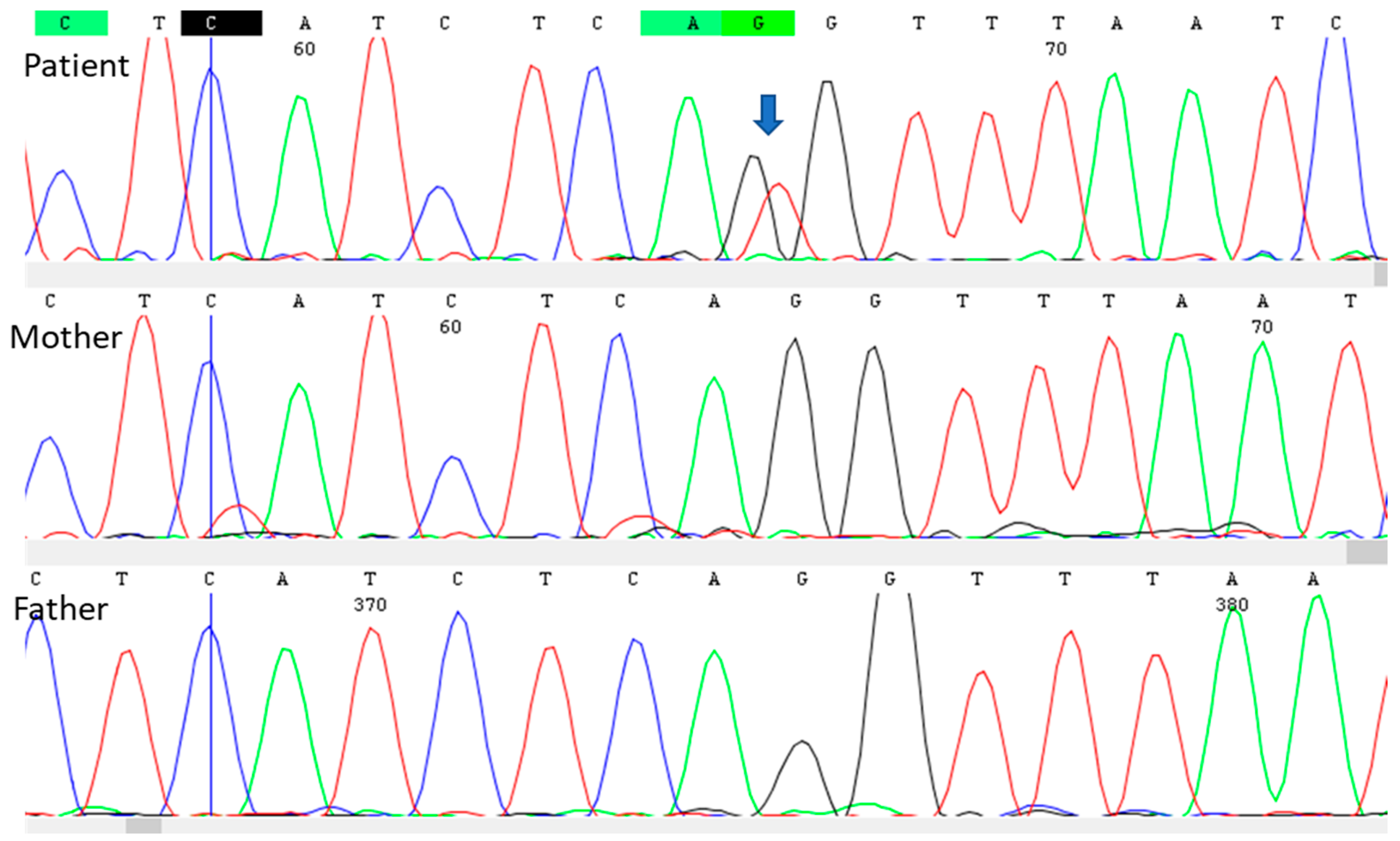 Uncommon Large and Bilateral Fibrous Cephalic Plaques in a Patient with ...