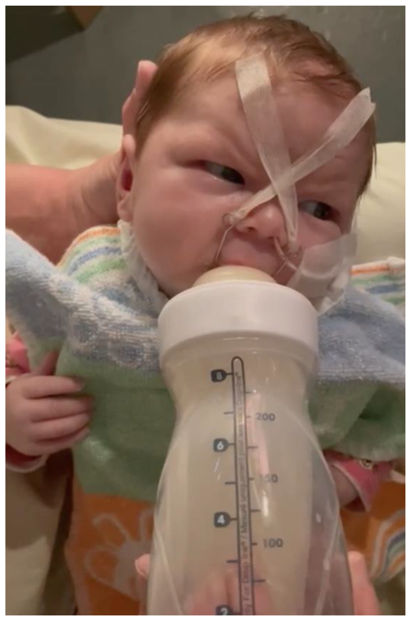 Caring for Infants with Robin Sequence Treated with the Tübingen ...