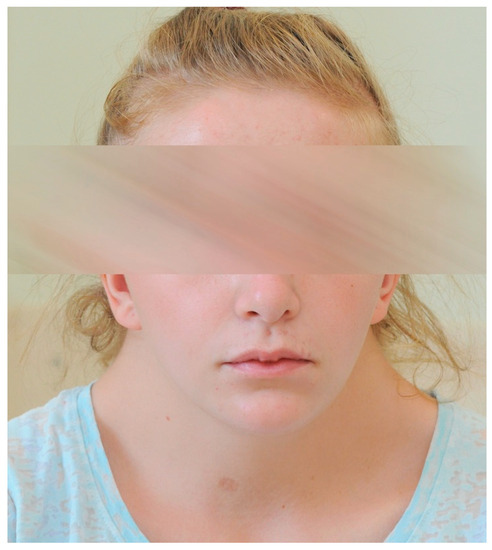 Anterior Uveitis and Coats Disease in a 16-Year-Old Girl with Noonan ...