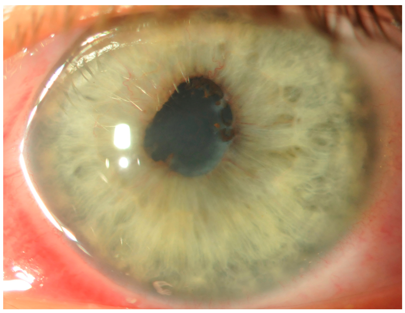 Anterior Uveitis and Coats Disease in a 16-Year-Old Girl with Noonan ...