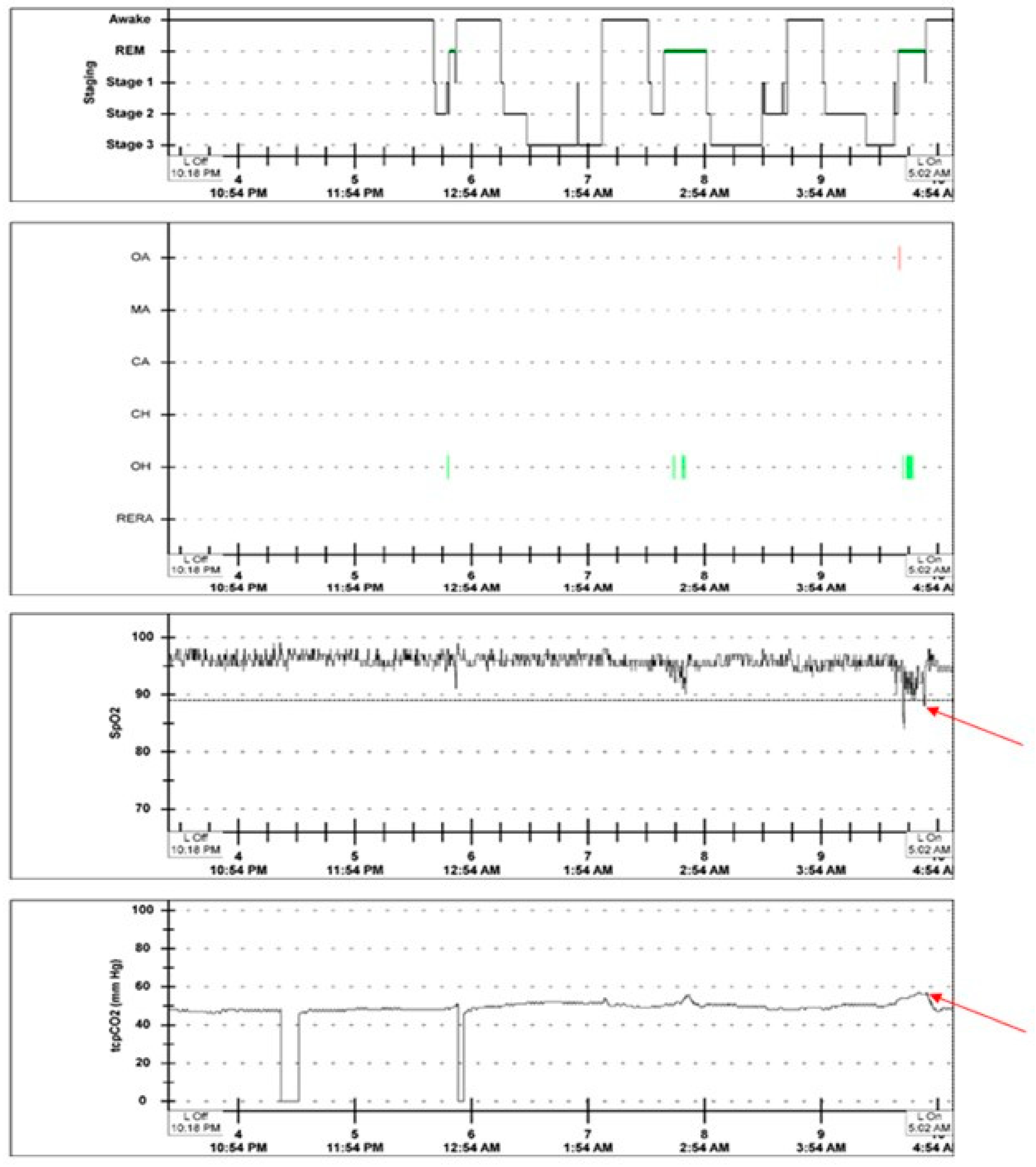 Sleep Disordered Breathing in Children with Neuromuscular Disease