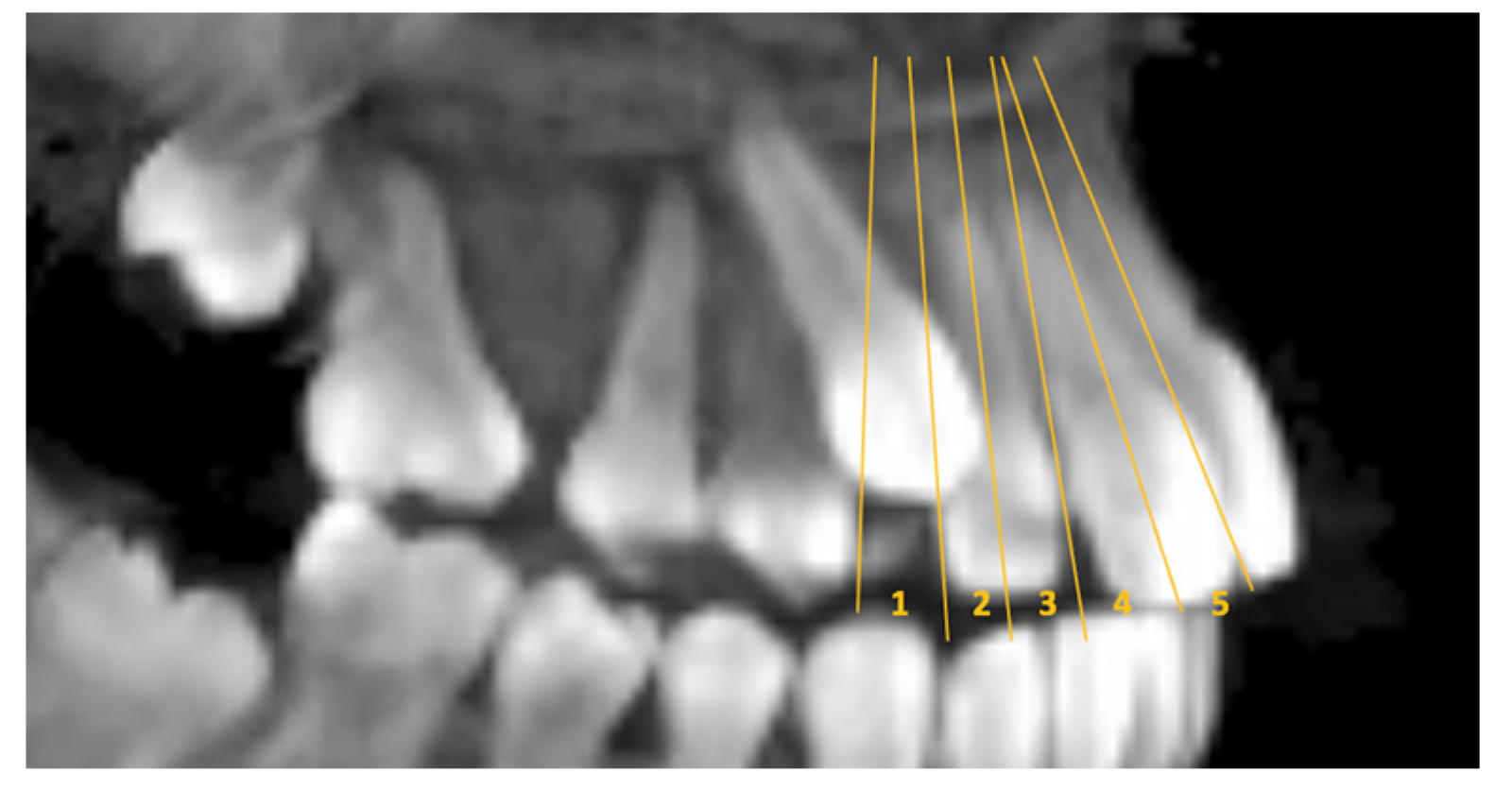 Characteristics of Unilaterally Impacted Maxillary Canines and Effect ...