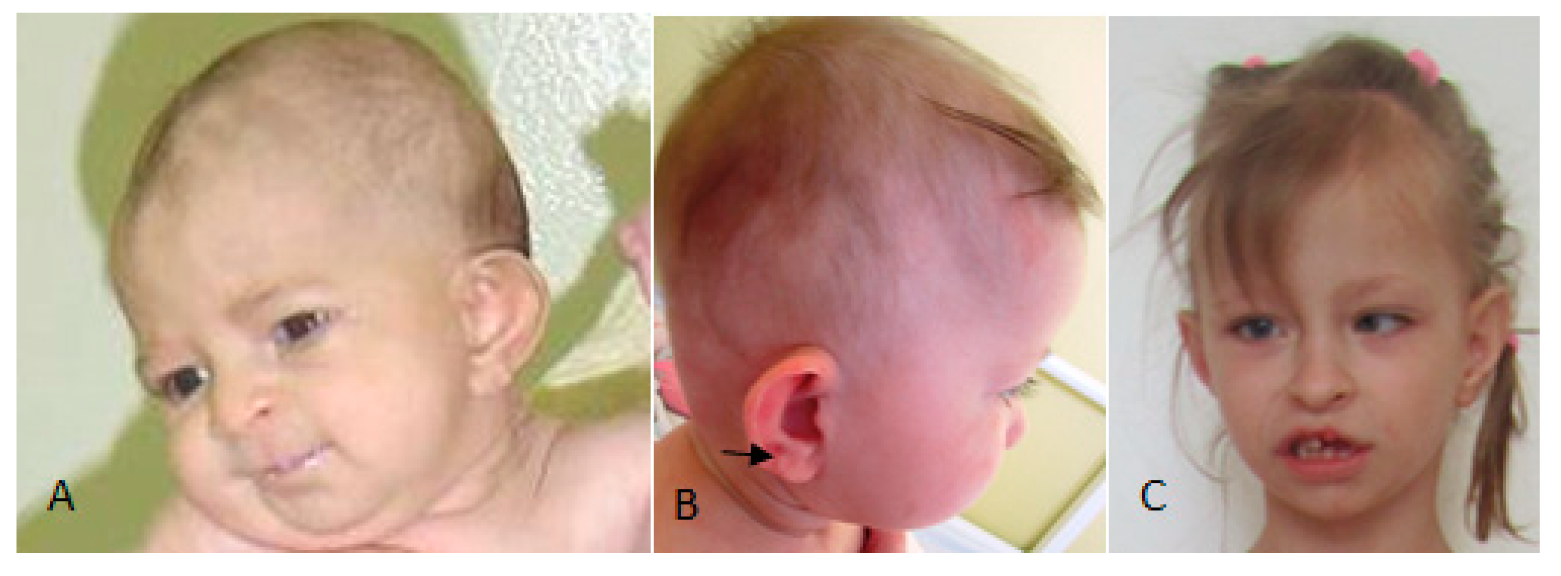 Cutaneous, Cranial, and Skeletal Defects in Children and Adults with ...