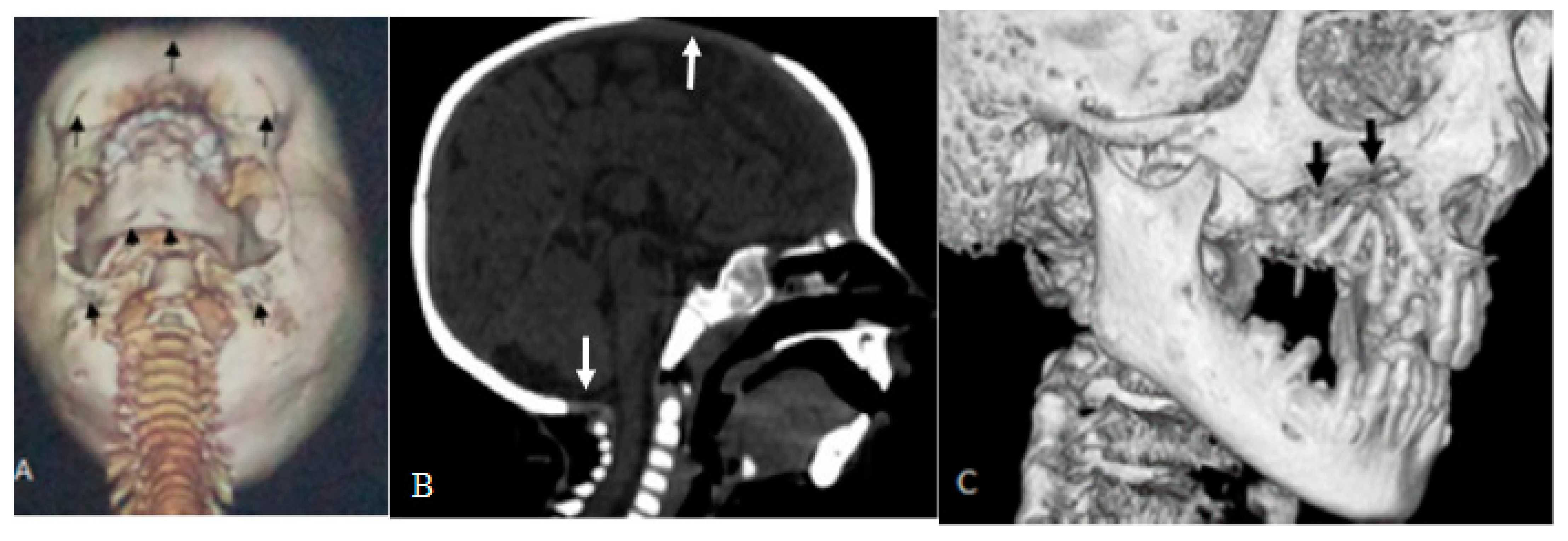 Cutaneous, Cranial, and Skeletal Defects in Children and Adults with ...