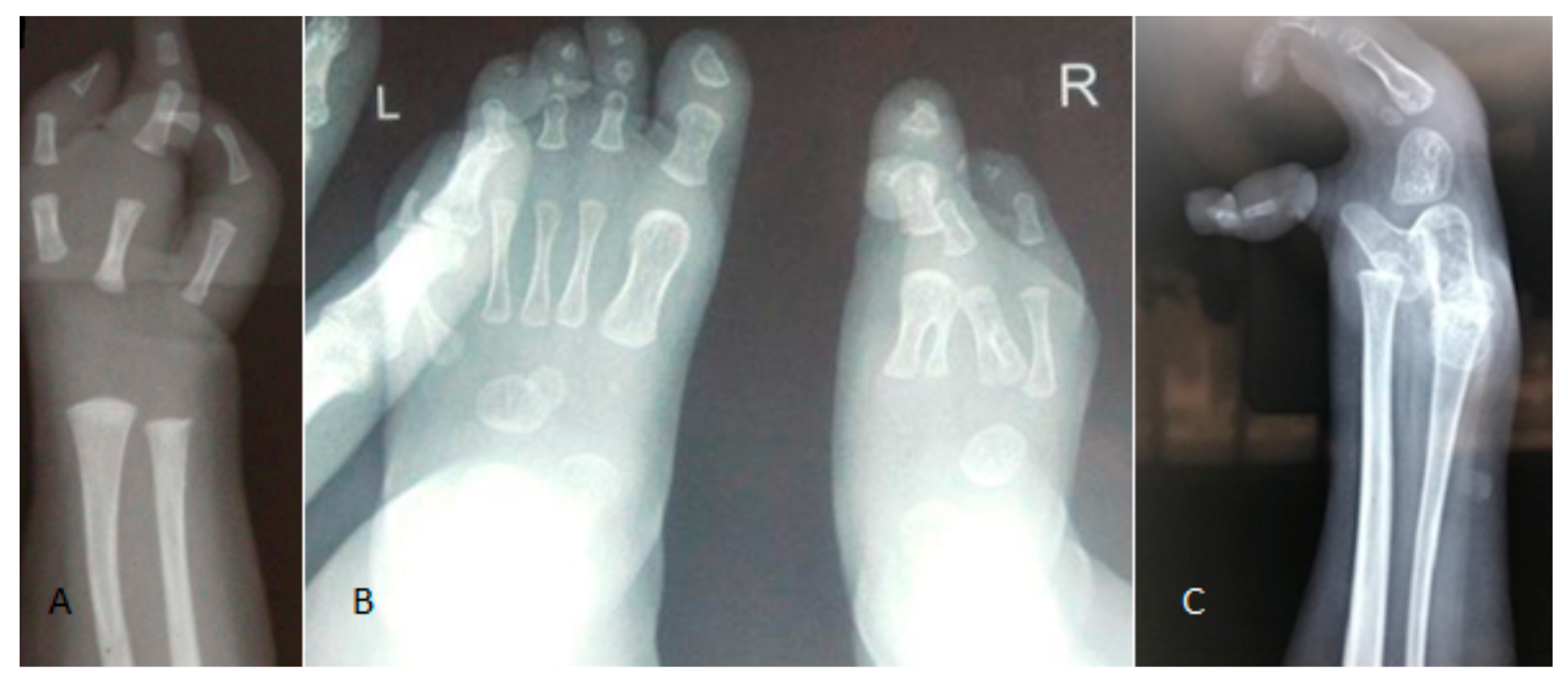 Cutaneous, Cranial, and Skeletal Defects in Children and Adults with ...