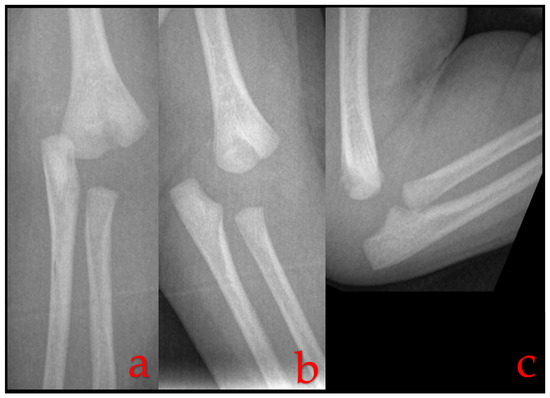 Transphyseal Humeral Separations: An Often-Missed Fracture