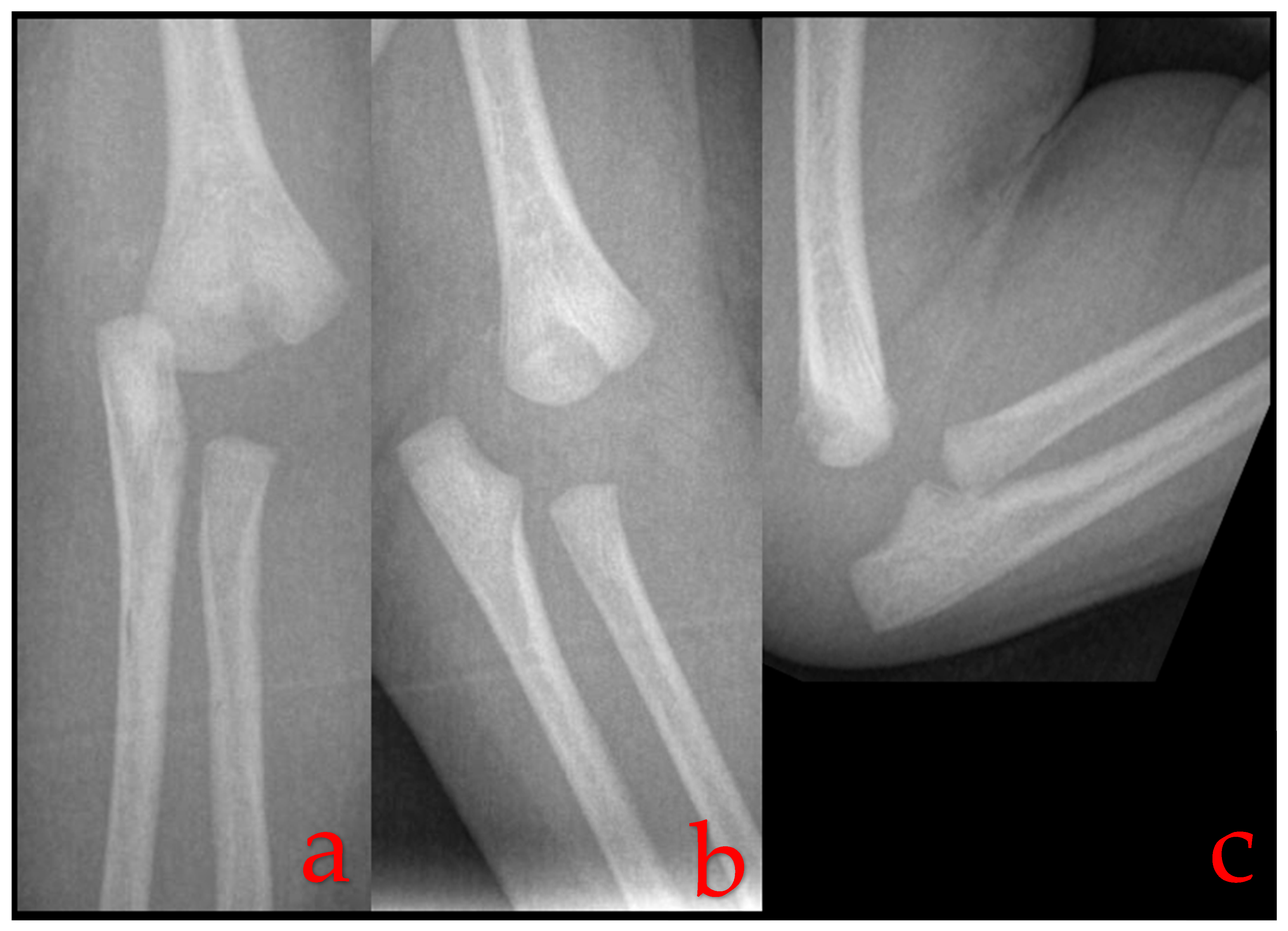Transphyseal Humeral Separations: An Often-Missed Fracture