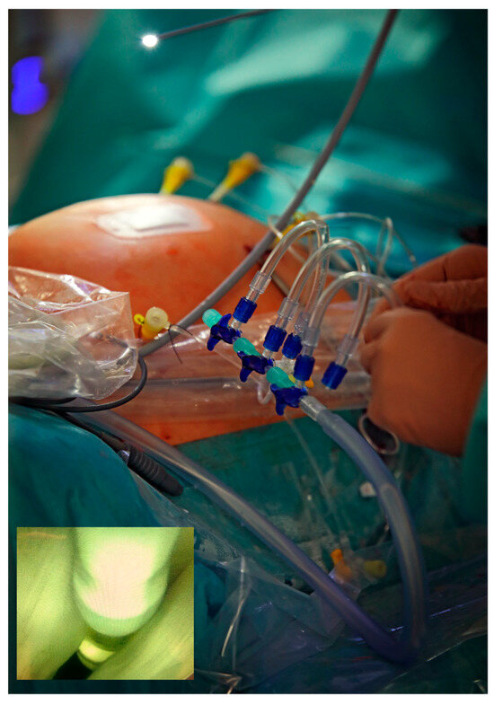 Case Report: Fetoscopic Laparoschisis (FETO-LAP)—A New Therapeutic ...