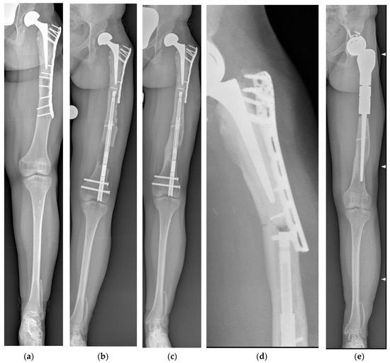 Lengthening Patients Previously Treated for Massive Lower Limb ...