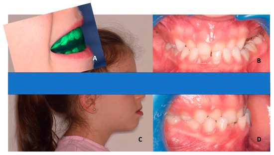 Elastodontic Appliances for the Interception of Malocclusion in Children: A Systematic Narrative ...