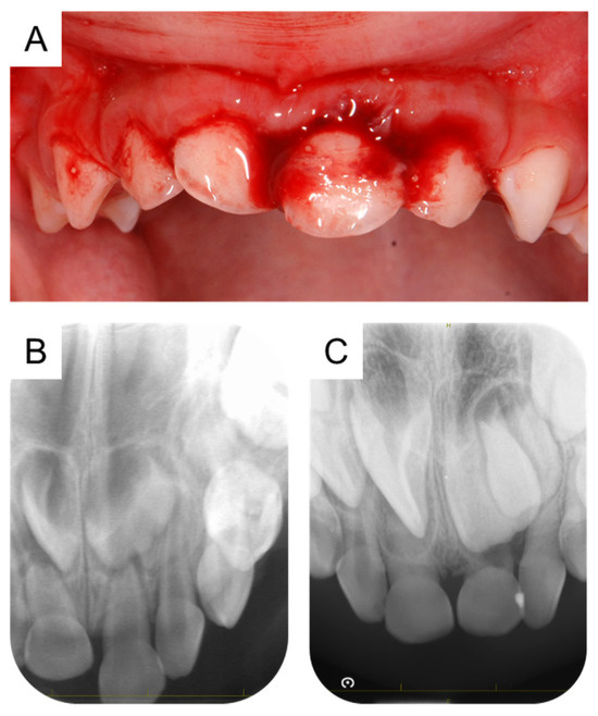 Fusion of a Tooth with a Supernumerary Tooth: A Case Report and ...