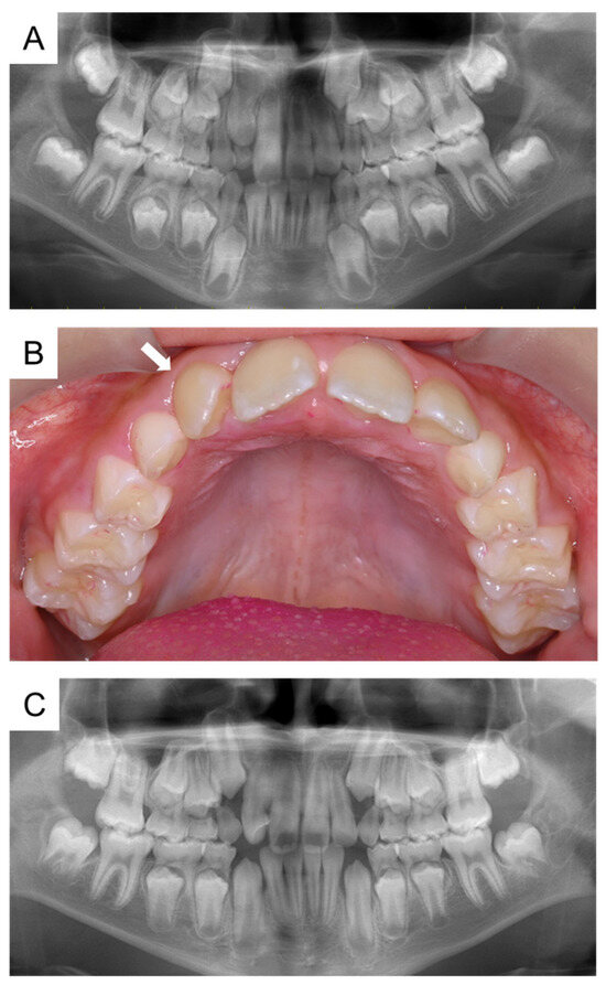 Fusion of a Tooth with a Supernumerary Tooth: A Case Report and ...