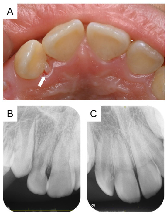 Fusion of a Tooth with a Supernumerary Tooth: A Case Report and ...