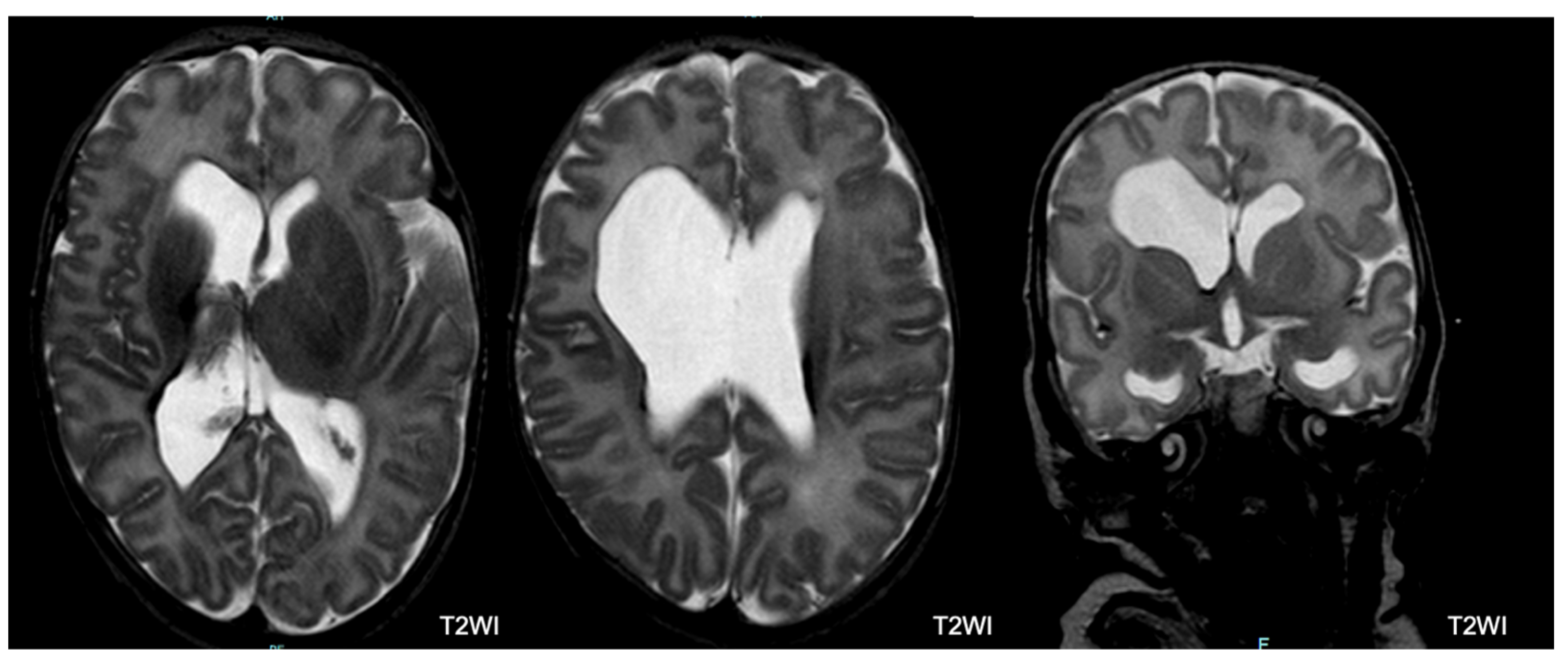 Neurodevelopmental Outcome and Neuroimaging of Very Low Birth Weight ...