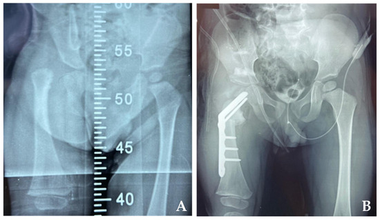 SUPERhip Reconstruction Treatment in Patients with Congenital Femoral ...