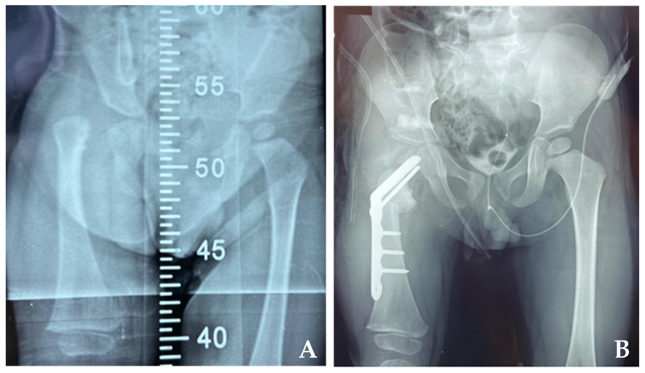 SUPERhip Reconstruction Treatment in Patients with Congenital Femoral ...