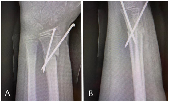 Case Report of a Unique Intra-Operative Finding in a Pediatric Distal ...