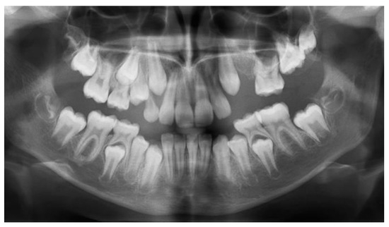 Rare Case of First Permanent Molar Primary Failure of Eruption with ...