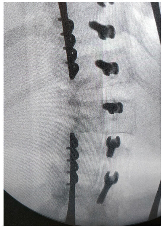 Posterior Vertebral Body Tethering: A Preliminary Study of a New ...