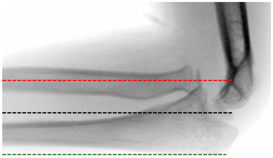 Missed Monteggia Injuries in Children and Adolescents: A Treatment ...