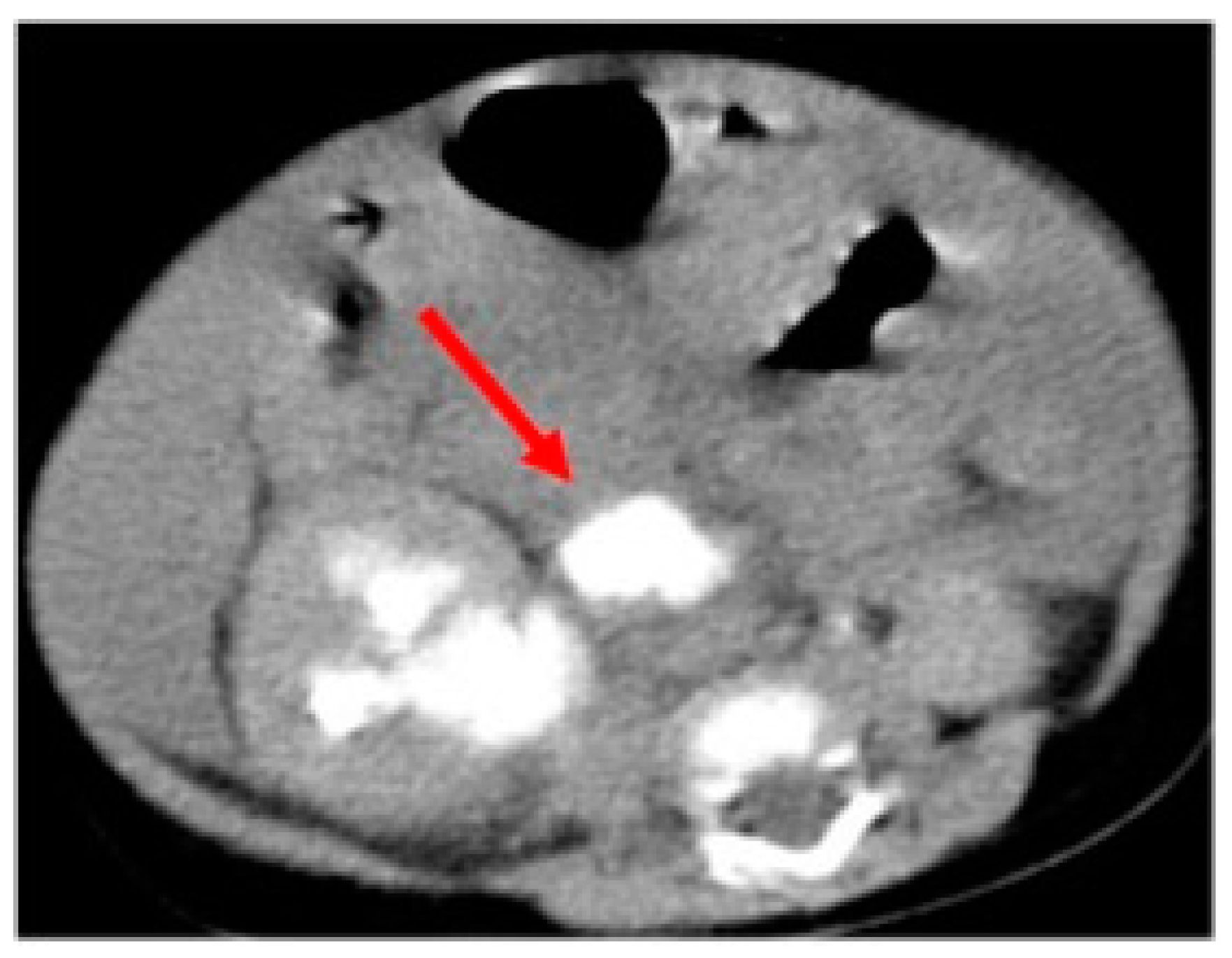 Combined Minimally Invasive Treatment of Pyeloureteral Junction ...
