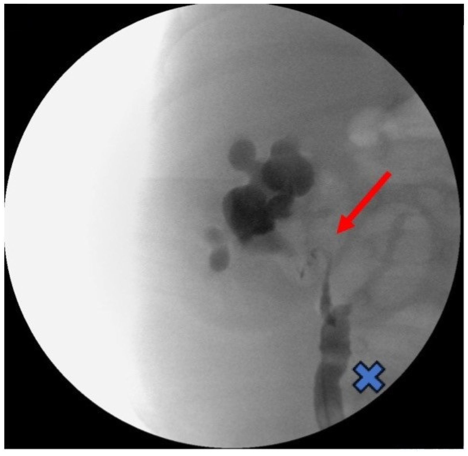Combined Minimally Invasive Treatment of Pyeloureteral Junction ...