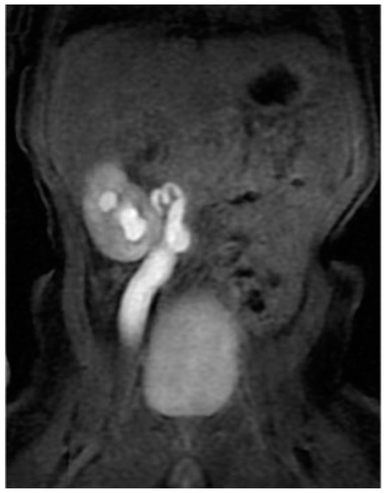 Combined Minimally Invasive Treatment of Pyeloureteral Junction ...