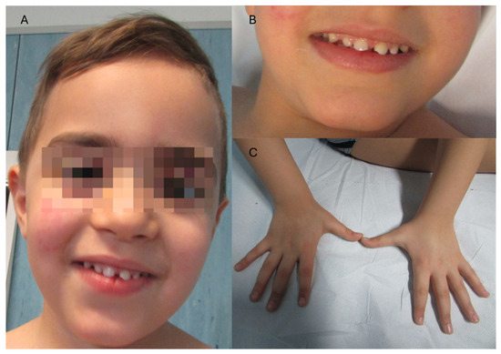 Expanding the Phenotype of the CACNA1C-Associated Neurological ...