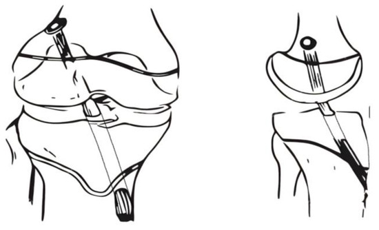 Pediatric ACL Reconstruction in Children—An Evaluation of the ...