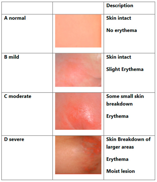 Bowel Management in Hirschsprung Disease—Pre-, Peri- and Postoperative ...