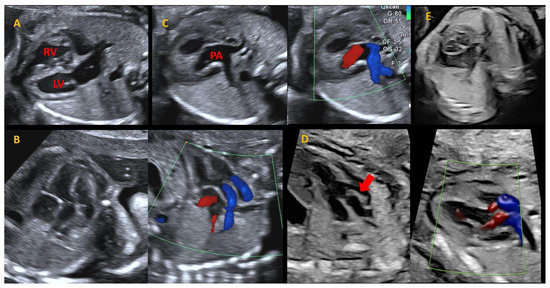 Complete Transposition of the Great Arteries in the Pediatric Field: A ...