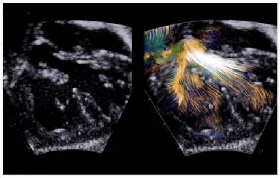 Complete Transposition of the Great Arteries in the Pediatric Field: A ...