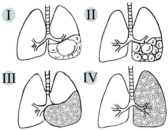 Congenital Lung Malformations: A Pictorial Review of Imaging Findings ...