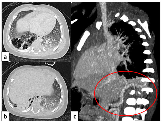 Congenital Lung Malformations: A Pictorial Review of Imaging Findings ...