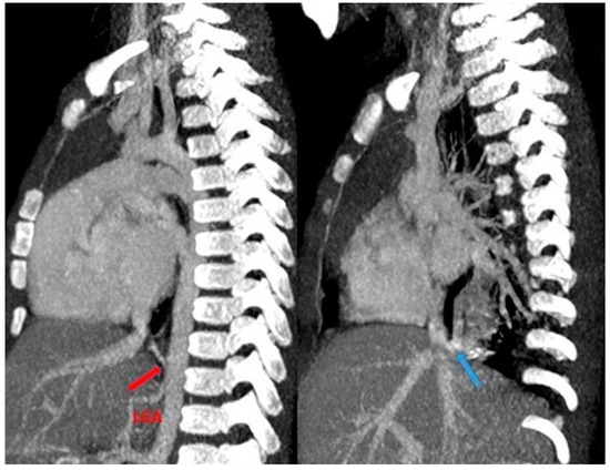 Congenital Lung Malformations: A Pictorial Review of Imaging Findings ...