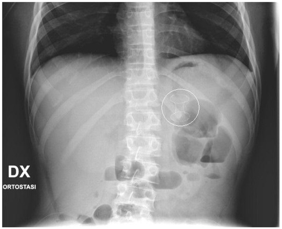 Children | Free Full-Text | Single Center Experience of Eus-Guided ...