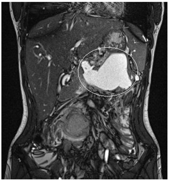 Single Center Experience of Eus-Guided Cystogastrostomy and Lumen ...
