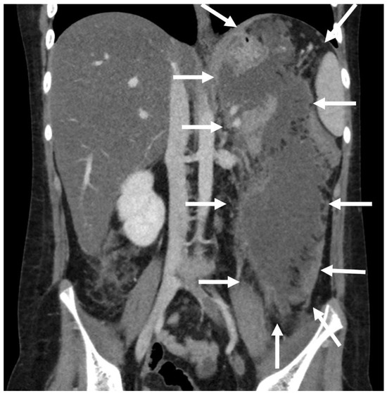 Single Center Experience of Eus-Guided Cystogastrostomy and Lumen ...