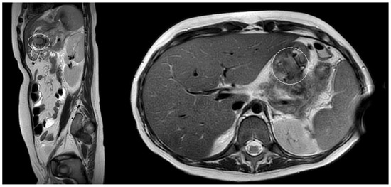 Single Center Experience of Eus-Guided Cystogastrostomy and Lumen ...