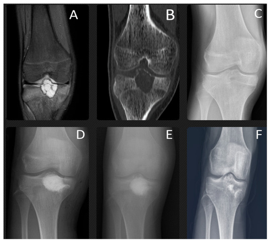 Management of Chondroblastoma in Pediatric Patients: 21 Years of Single ...
