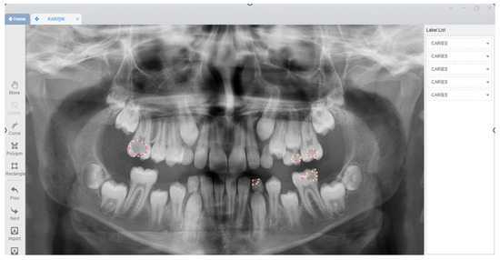 A Deep Learning Approach to Automatic Tooth Caries Segmentation in Panoramic Radiographs of ...