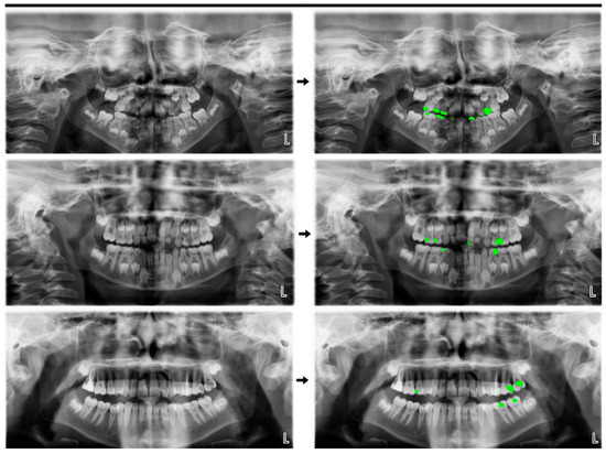 A Deep Learning Approach to Automatic Tooth Caries Segmentation in Panoramic Radiographs of ...