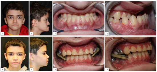 Maxillary Hypoplasia and Non-Invasive Ventilation: Literature Review and Proposed New Treatment ...