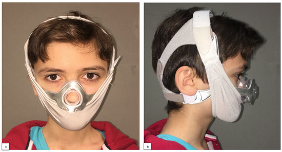 Maxillary Hypoplasia and Non-Invasive Ventilation: Literature Review ...